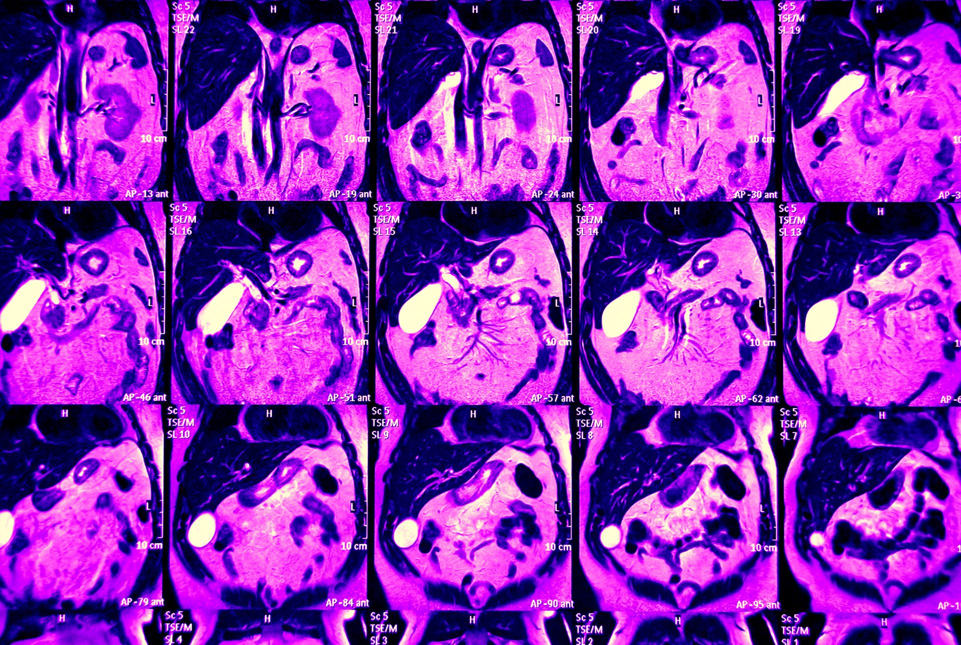 Racial Disparities Found In Early onset Colon Cancer Survival Rates