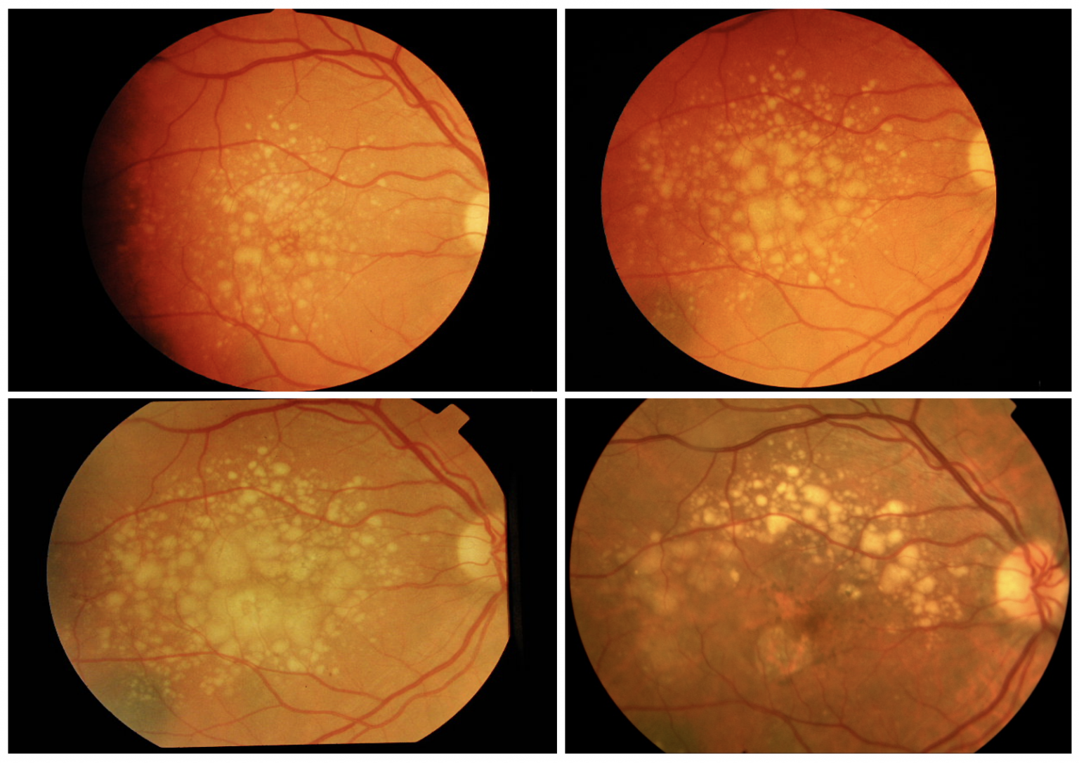 What Can Be Done For Age Related Macular Degeneration at Louise Collier ... What Can Be Done For Age Related Macular Degeneration at Louise Collier ...